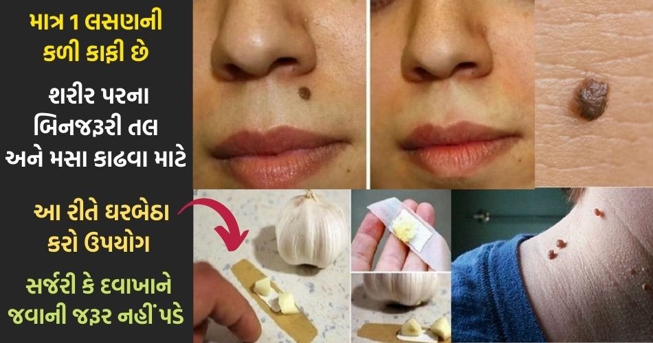 સર્જરી કે દવા વગર જ શરીર પરના બિનજરૂરી તલ અને મસા નીકળી જશે, જાણી લો આ ...